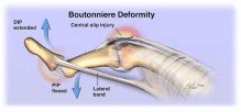 Boutonniere Versus Pseudoboutonniere Deformities Pathoanatomy