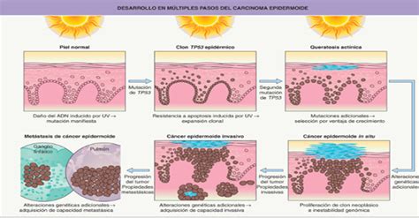 Carcinoma Epidermoide