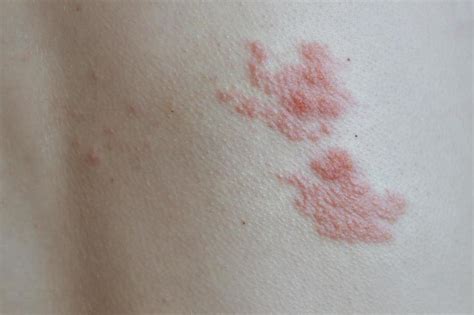 Lupus And Shingles At Kirsten Nord Blog