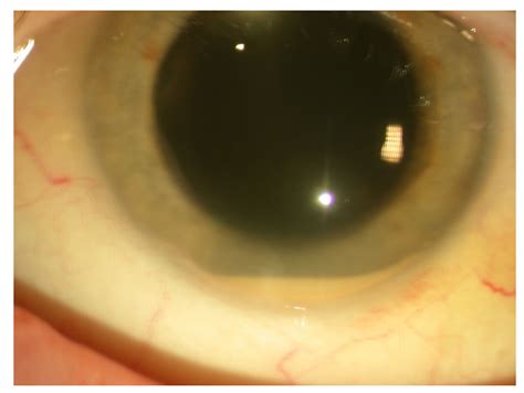 Granulomatous Keratic Precipitates