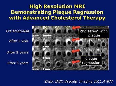 My Plaque Stabilization Regression Therapy Advanced Cholesterol