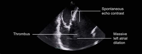 Echo Basics Mitral Stenosis • Litfl • Radiology Library