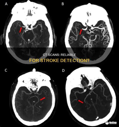 Ct Scans Reliable For Stroke Detection Medshun