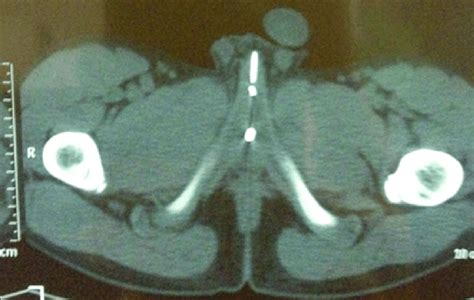 Axial Plain Ct Image Of The Pelvis Shows A Hyperdense Metallic Foreign