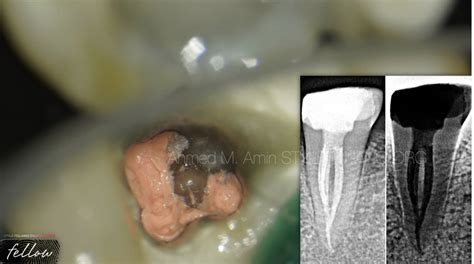 Management Of C Shaped Canal System Style Italiano Endodontics
