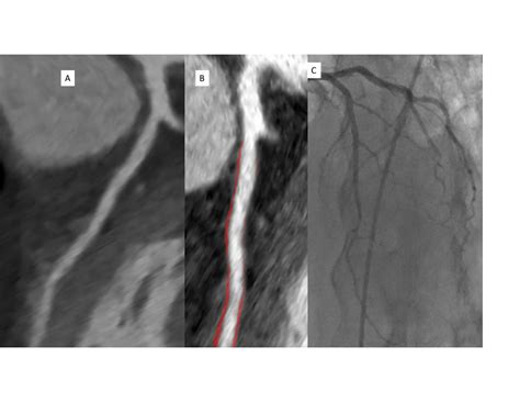 Patient With Grade 1 Cav And Normal Ccta Panel A Shows A Curved Download Scientific Diagram