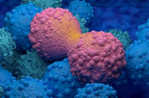 Keynote 522 Trial Results Show Neoadjuvant Keytruda Plus Chemo Improves