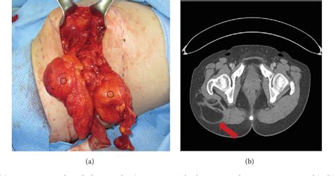 Figure 1 From Treatment For Intramuscular Lipoma Frequently Confused