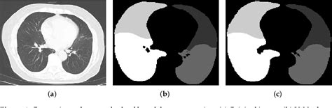 Figure 4 From Detection And Classification Of Bronchiectasis Based On
