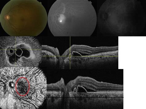 En Face Imaging Of The Choroid In Polypoidal Choroidal Vasculopathy