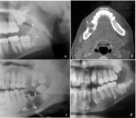 Multilocular Cyst Cyst With Internal Structure That Was Predominantly Download Scientific