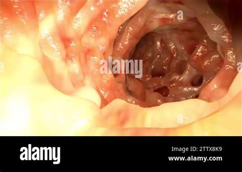 Amoebic Colitis Stock Videos And Footage Hd And 4k Video Clips Alamy