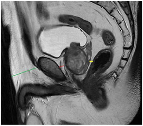 Radiologic Assessment Of Periprostatic Fat As An Indicator Of Prostate