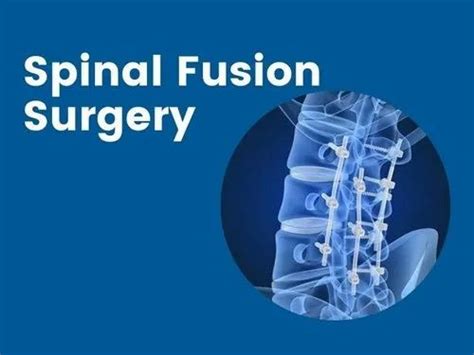 Spinal Fusion Surgery In Mumbai At Best Price In Mumbai Id 25850200012