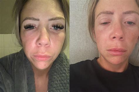Botox Gone Wrong Masseter Botox Gone Wrong Before And After Over