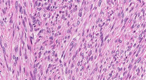 Leiomyosarcoma Of The Skin Ottawa Atlas Of Pathology