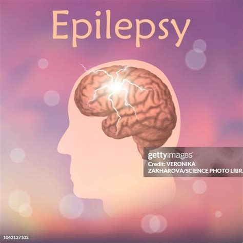 107 Epilepsy High Res Illustrations Getty Images
