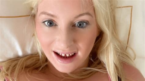 I Love My Beautiful Smile After Getting Turkey Teeth I Went From Jaws