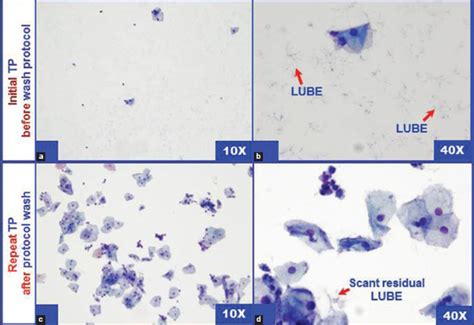 Etiologic Factors Related To Unsatisfactory Thinprep Cervical Cytology