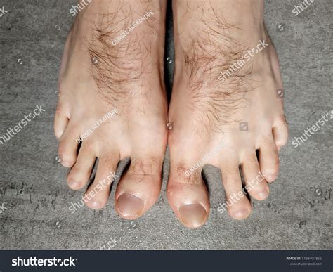 Why Do I Have Hair Growing On My Feet At Richard Meagher Blog