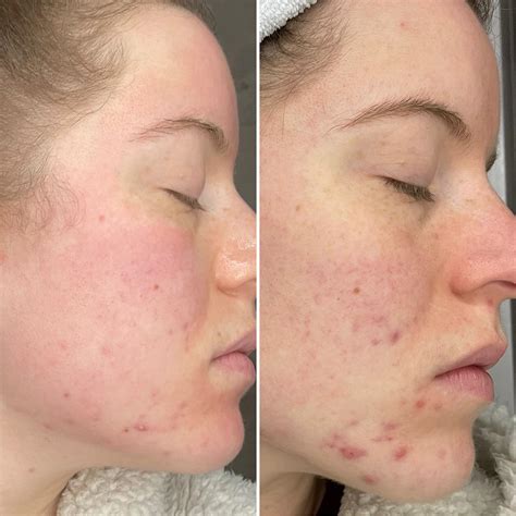 122 Best Epiduo Images On Pholder Skincare Addiction Acne And