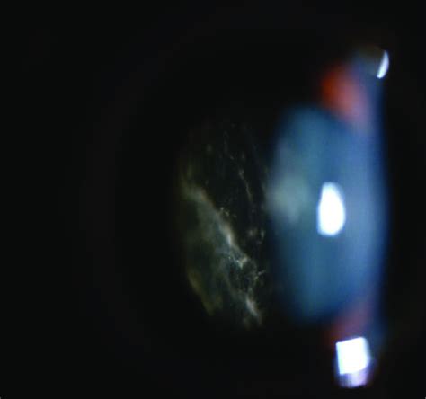 Intermediate Uveitis