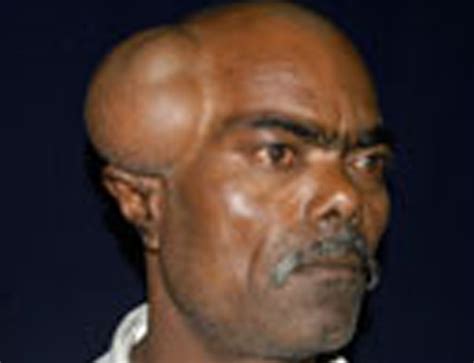 Vascular Malformation Hyderabad Cleft Society