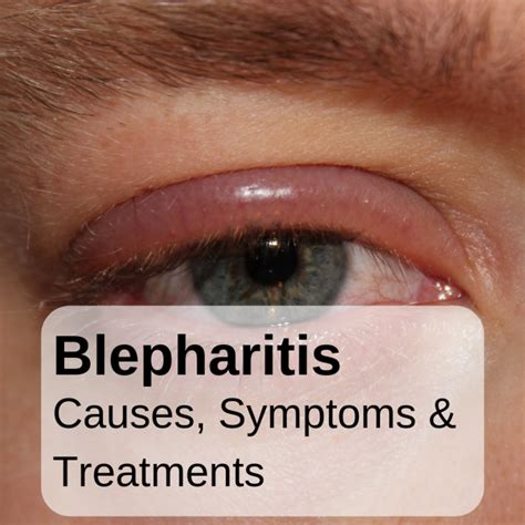 Seborrheic Blepharitis