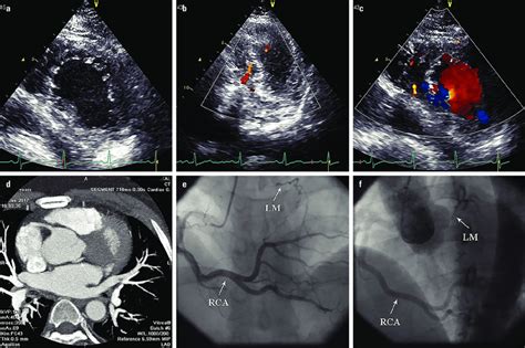 Echocardiography Shows A Left Ventricular Noncompaction With