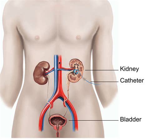 Nephrostomy Tube Care