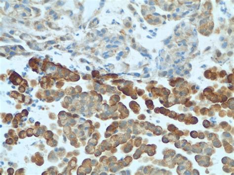 Primary Goblet Cell Carcinoid Tumor Staining Positive For Download