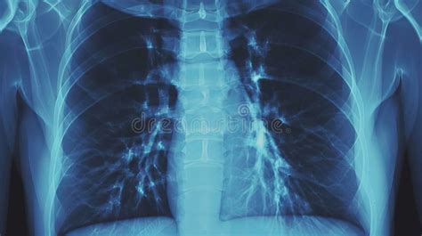 Medical Imaging Enlarged Heart On Chest X Ray Exam For Dilated