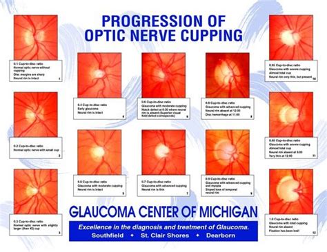 Progression Of Optic Nerve Cupping Eye Facts Eye Health Optometry
