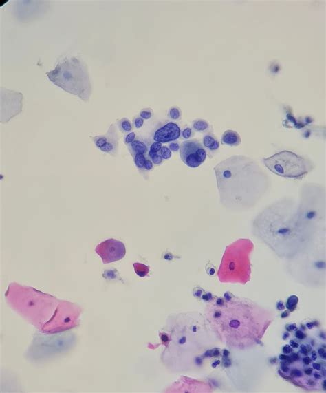 Sara Salih On Linkedin Thinprep Pap Smear 15 Comments