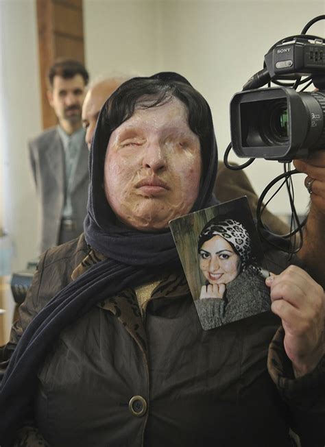 Acid Blinded Iranian Halts Eye For Eye Retribution Northwest Arkansas