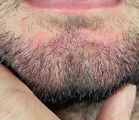 7 Common Causes Of Patchy Beard Growth