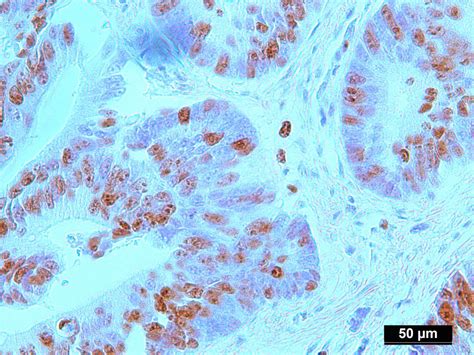 Genomic Dna Extracted From Pure Human Colon Adenocarcinoma Cells