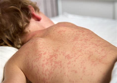 What Is Measles Look Like