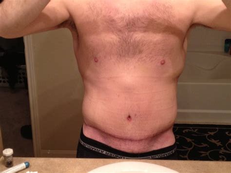 Xiphoid Process Lump