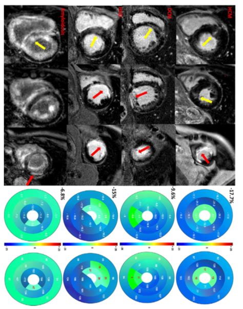 Patient Specific Cardiac Magnetic Resonance Feature Tracking Approach