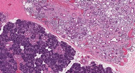 Sialodenitis Ottawa Atlas Of Pathology