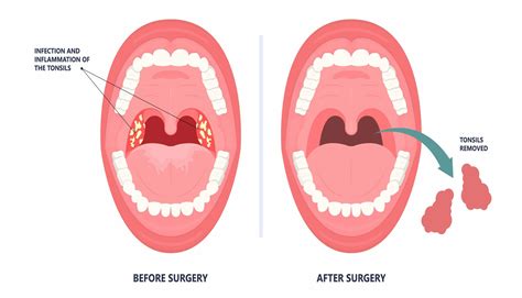 Tonsillectomy In Turkey Cost Of Tonsillectomy In Turkey