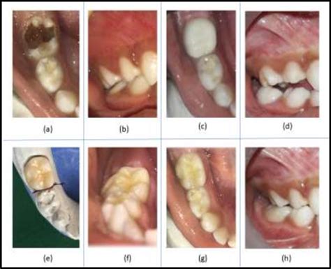 Shows A Grossly Decayed Lower Right Mandibular Primary Molar 85