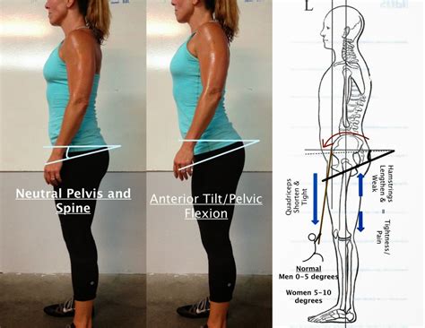 La Anteversión Y Retroversión Pélvica Desde Una Perspectiva Evolutiva