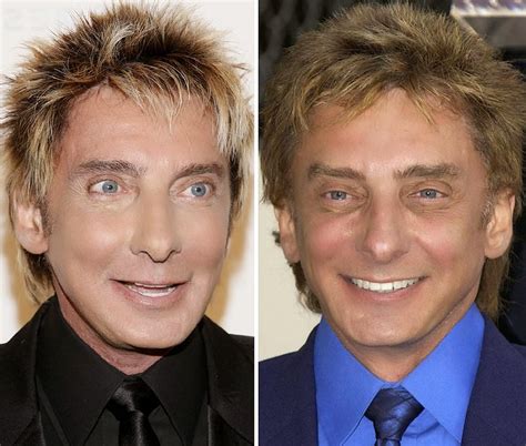 Barry Manilow Plastic Surgery Facelift Nose Job Before And After Photos