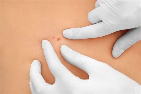 Enfermedades De Transmisión Sexual En Cdmx Safe Care