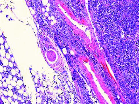 Histology Diffuse Infiltration Of The Lymph Node By Lymphoma With
