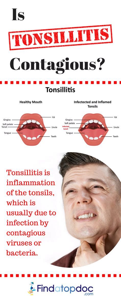Is Tonsillitis Contagious Pdf