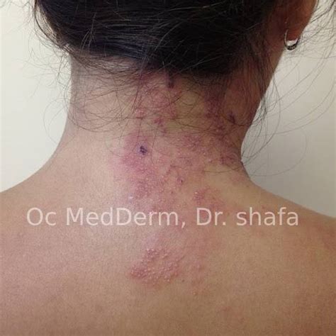Shingles Scars Pictures
