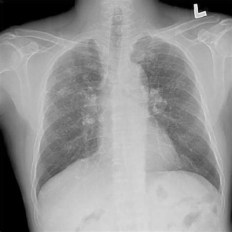 Figure1initial Chest X Ray Showing Tiny Lung Nodules In Both Fields